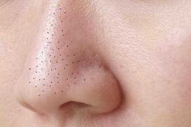 cara menghilangkan komedo dengan bahan alami